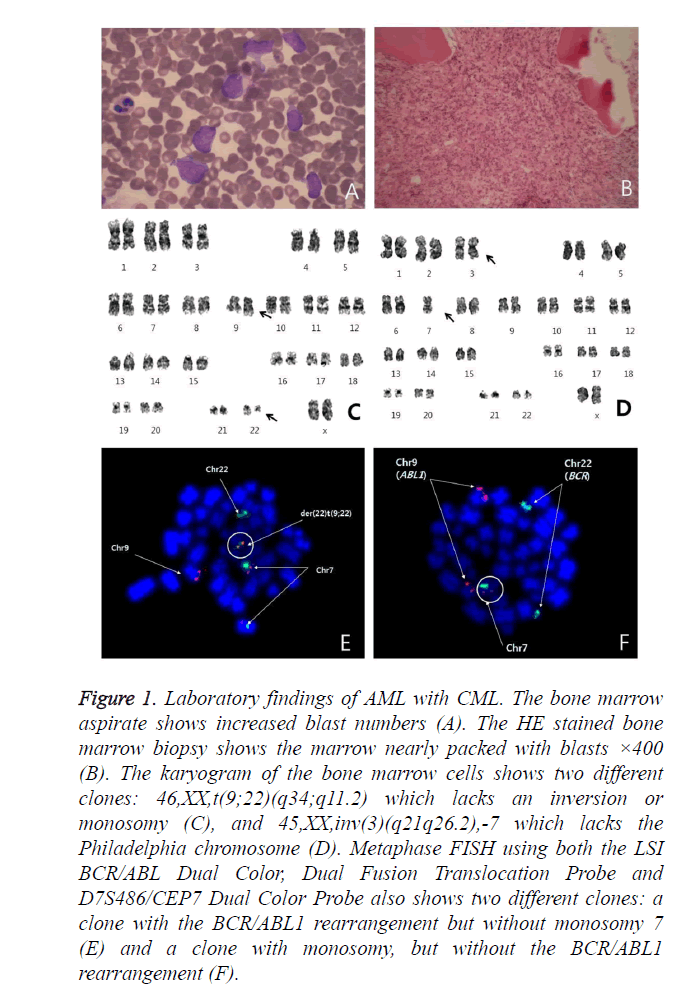 Demonstration of a chronic myelogenous l | Biomedical Research